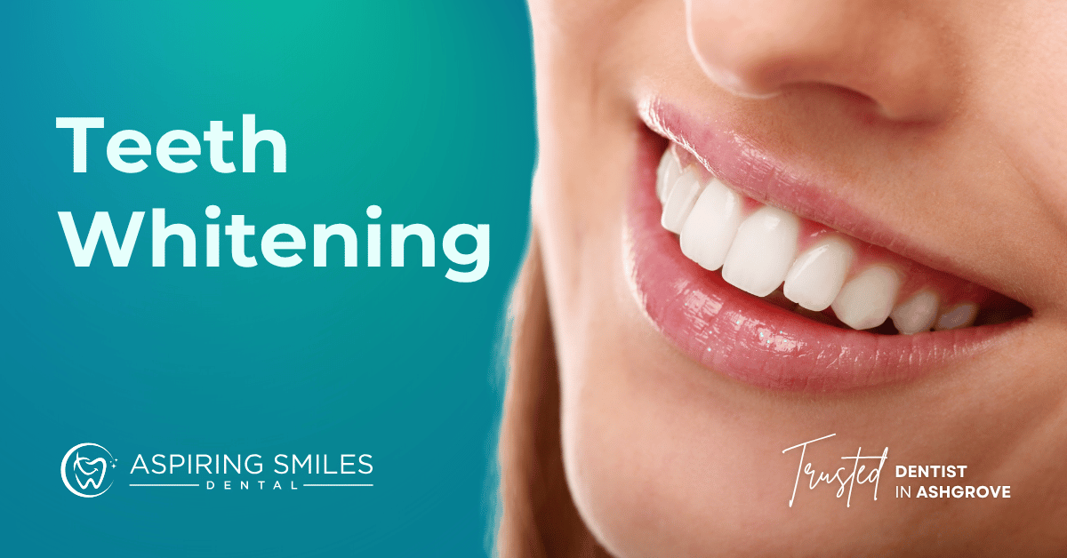 Teeth Whitening in Ashgrove – Aspiring Smiles Dental